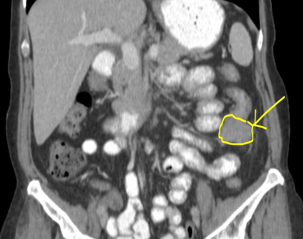 End to end Triangular Anastomosis using a TA stapler